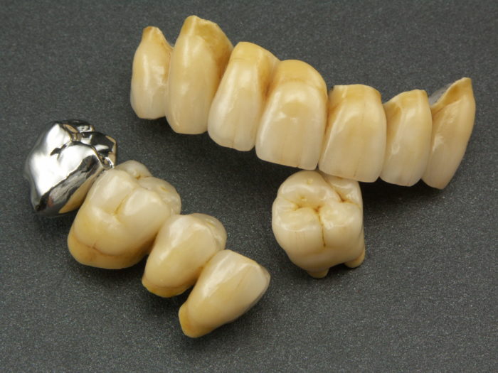 Céramo-métal - dental art technology - couronne céramo-métallique ccm ...