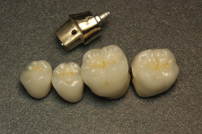 Céramo-métal - dental art technology - couronne céramo-métallique ccm ...