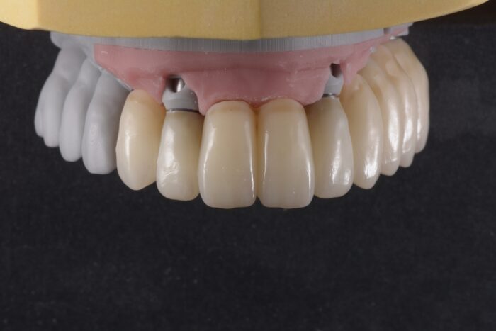 Nos Prothèses implantaires - Dental Art Technology - couronne dentaire transvissee tibase ...
